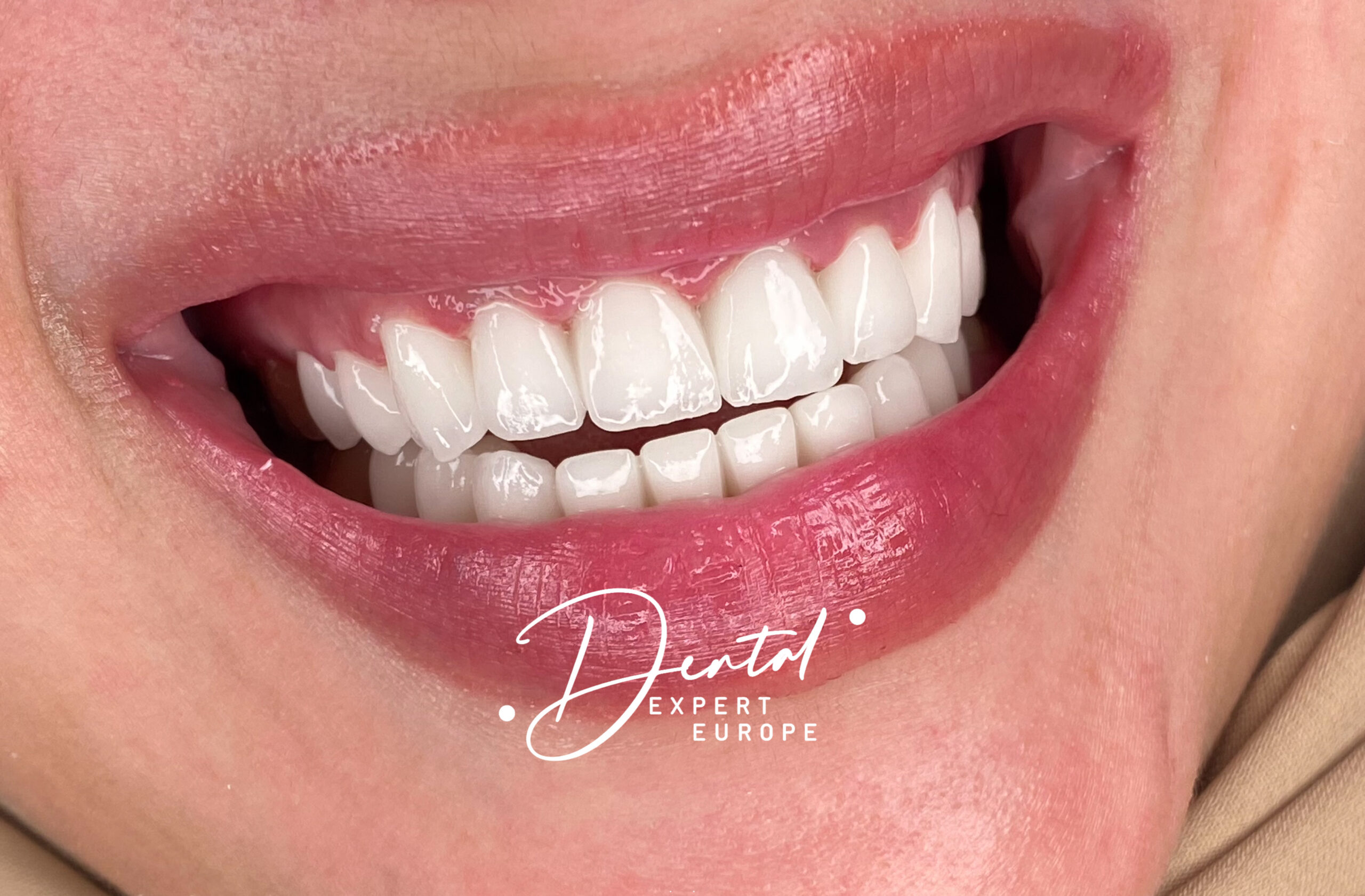 Smile Design – Dental Expert Clinic