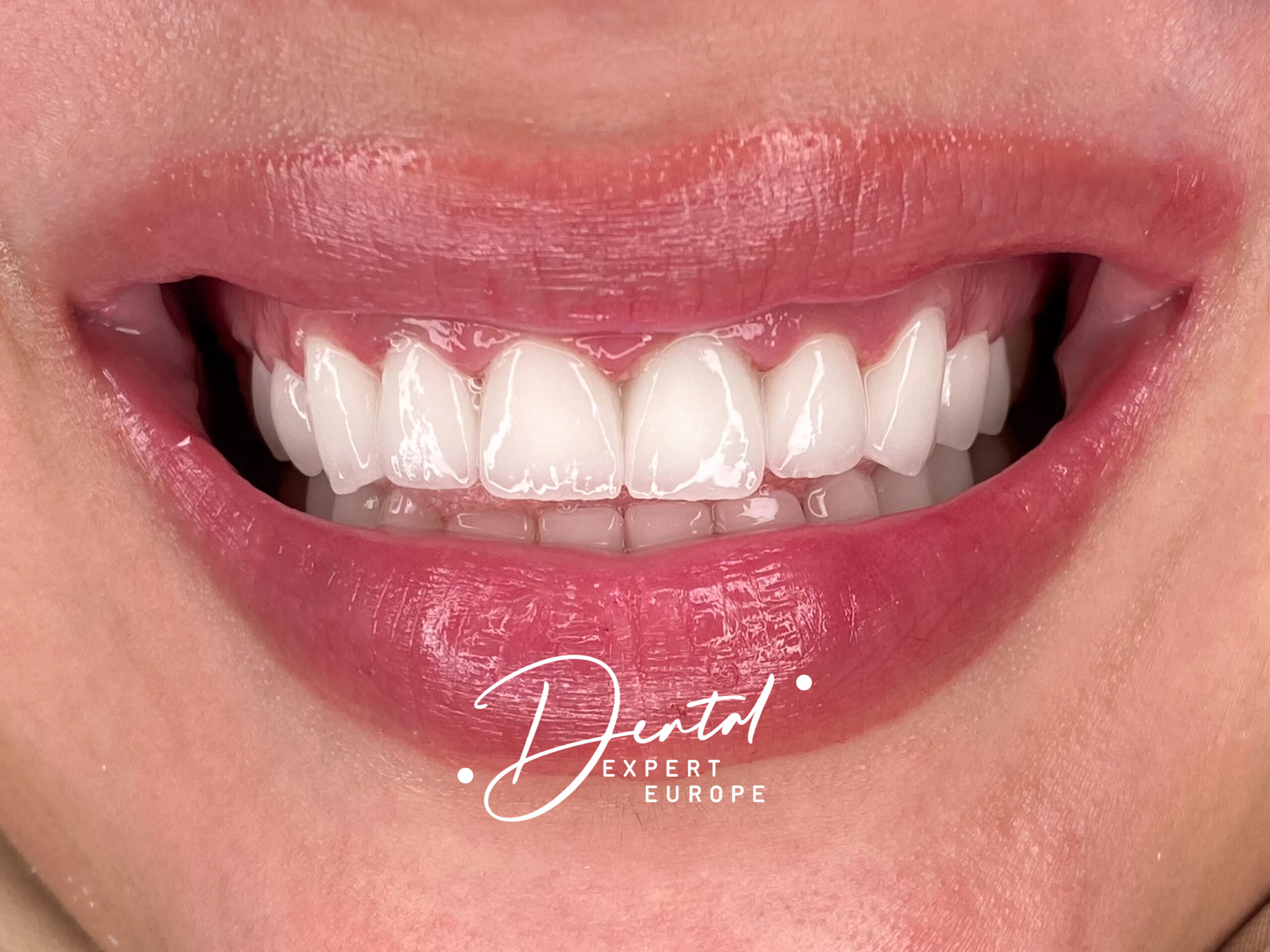 Smile Design – Dental Expert Clinic